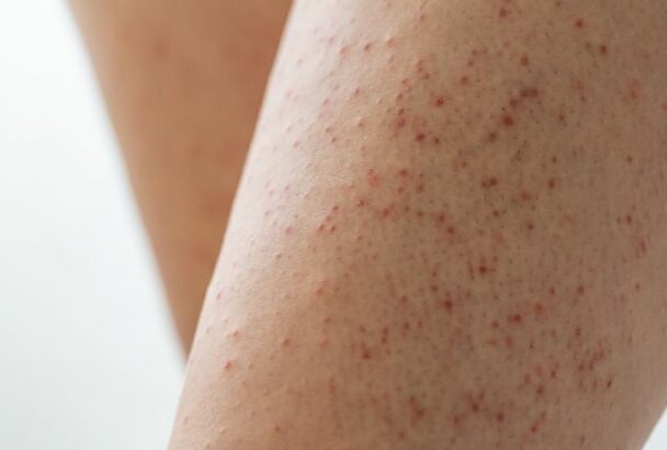 15 Signs That You Are Vitamin Deficient - Housely