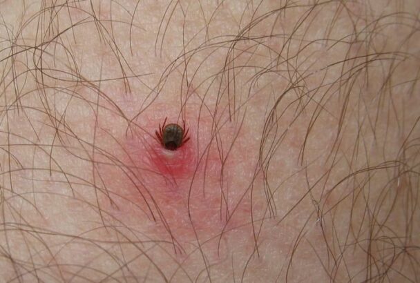 15 Things About Ticks Everyone Should Know - Housely