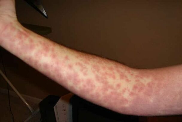 15 Common Causes of Red Dots on Your Skin - Housely