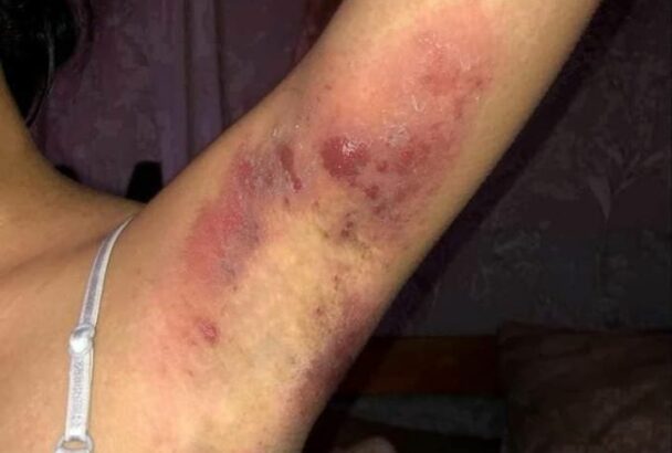 15 Common Causes of Red Dots on Your Skin - Housely