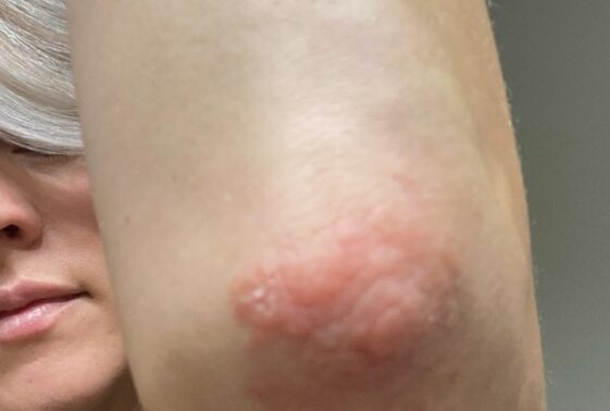 15 Common Causes of Red Dots on Your Skin - Housely