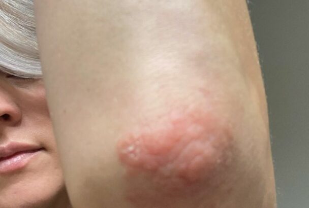 15 Common Causes of Red Dots on Your Skin - Housely